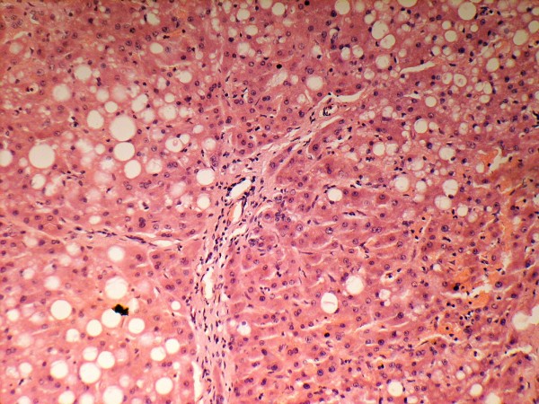 Aplasia tibial – ectrodactilia | FEMEXER