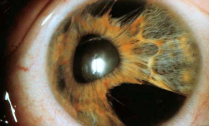 Síndrome renal-coloboma | FEMEXER