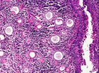 Colestasis intrahepática familiar progresiva | FEMEXER