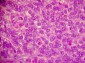 Colestasis intrahepática familiar progresiva tipo 1 | FEMEXER