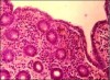 Colitis microscópica | FEMEXER