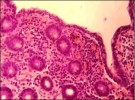 Colitis microscópica | FEMEXER