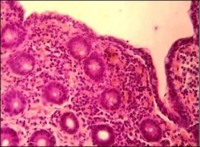 Colitis microscópica | FEMEXER