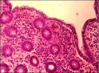 Colitis microscópica | FEMEXER