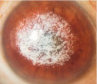 Distrofia corneal epitelial de Lisch | FEMEXER