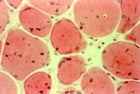 Miopatía miotónica proximal | FEMEXER