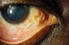 Loiasis | FEMEXER