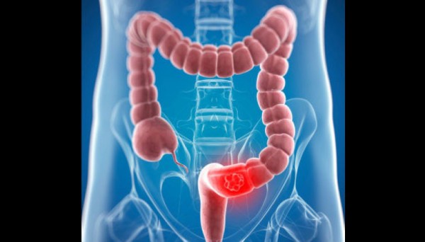 Proctitis por radiación | FEMEXER