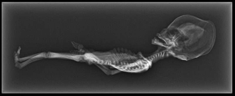 Discondrosteosis de Léri-Weill | FEMEXER