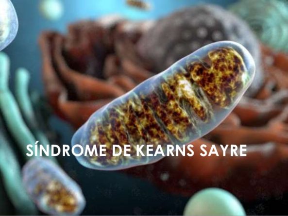 Síndrome de Kearns-Sayre | FEMEXER
