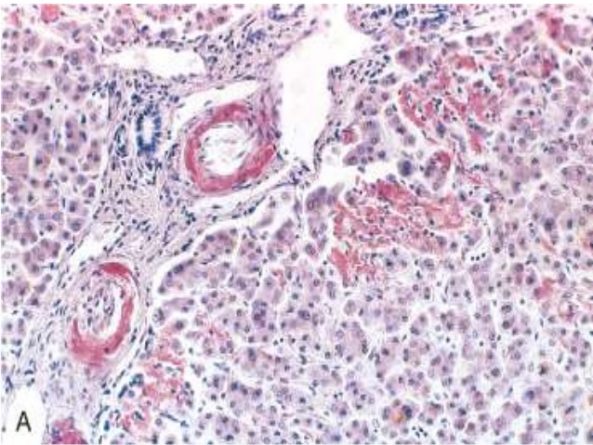 Síndrome de Muckle-Wells | FEMEXER