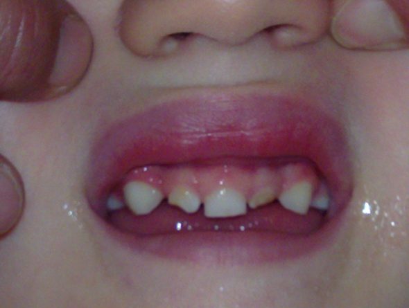 Síndrome de incisivo central maxilar medio único | FEMEXER