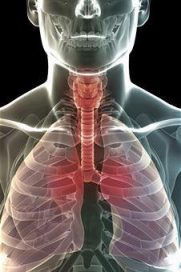 Traqueomalacia congénita | FEMEXER