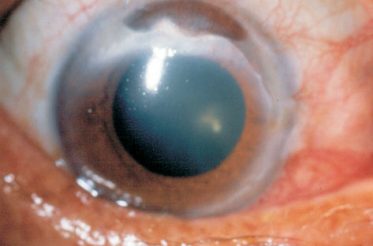 Anomalía de Peters | FEMEXER